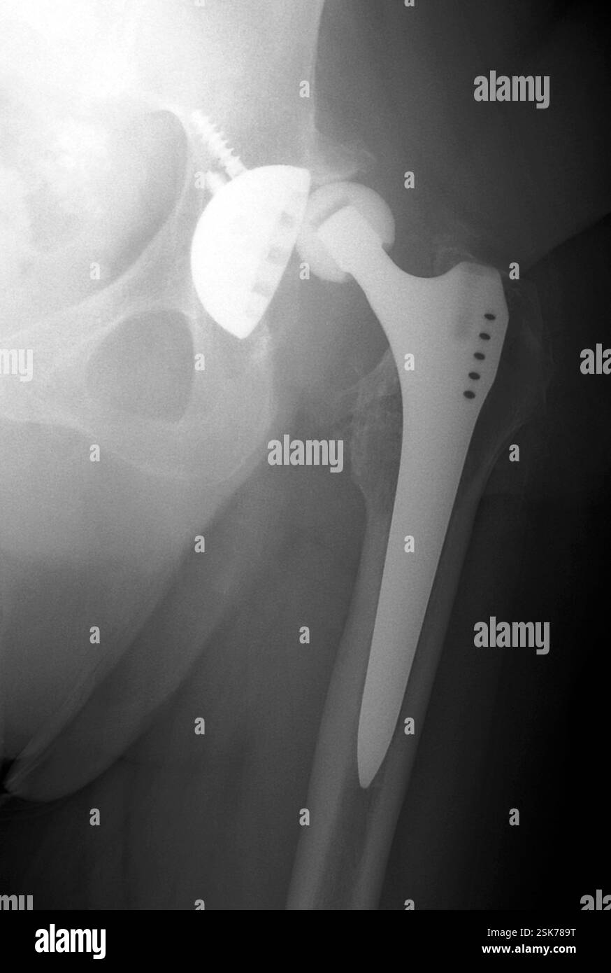 X-ray (front view) of the pelvis of a patient, showing complete ...