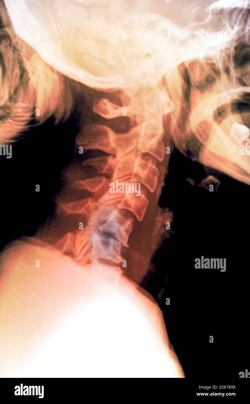 Coloured X-ray (side view) of the cervical spine of the neck of a 65 ...