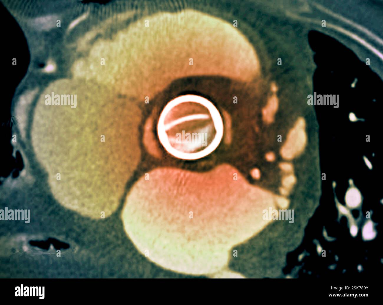 Coloured two-dimensional Computed Tomography (CT) angio scan through ...