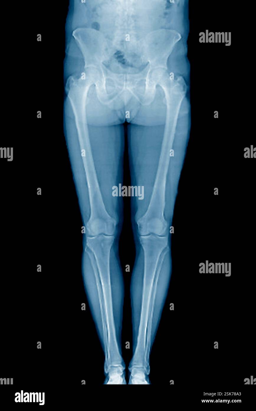 Coloured X-ray (frontal view) of the healthy pelvis and leg bones of a ...