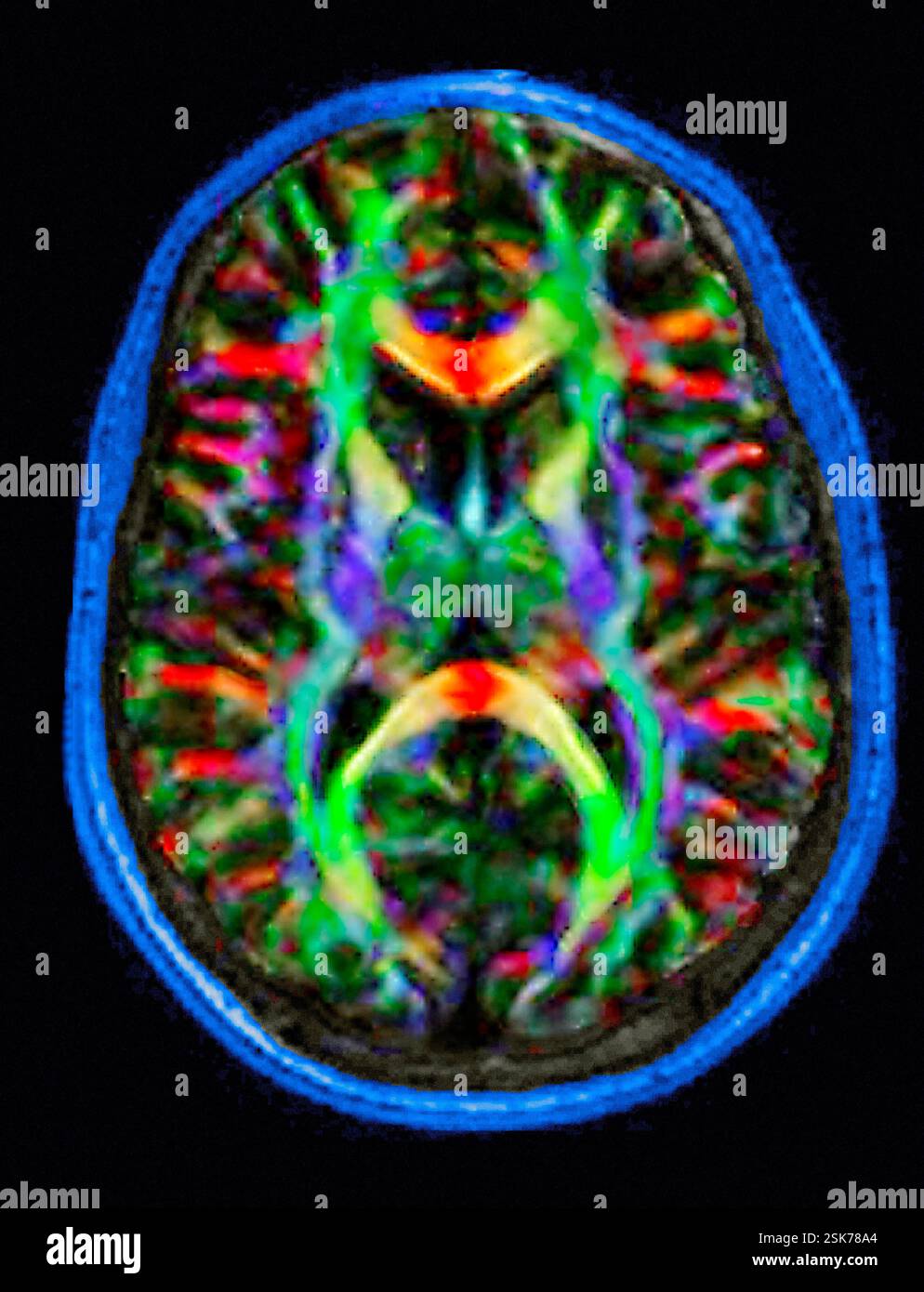 Coloured Diffusion Tensor Imaging Dti Scan In Axial Section Through The Brain Showing The