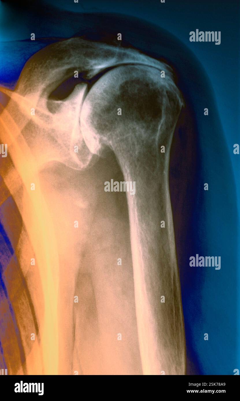 Coloured X-ray (front view) of the shoulder of an 89 year old female ...