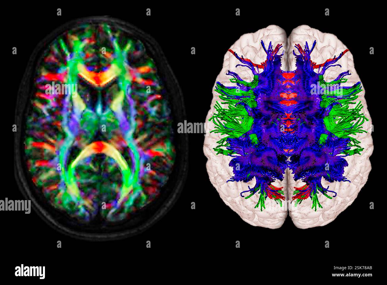 At Left Coloured Diffusion Tensor Imaging Dti Scan In Axial Section Through The Brain
