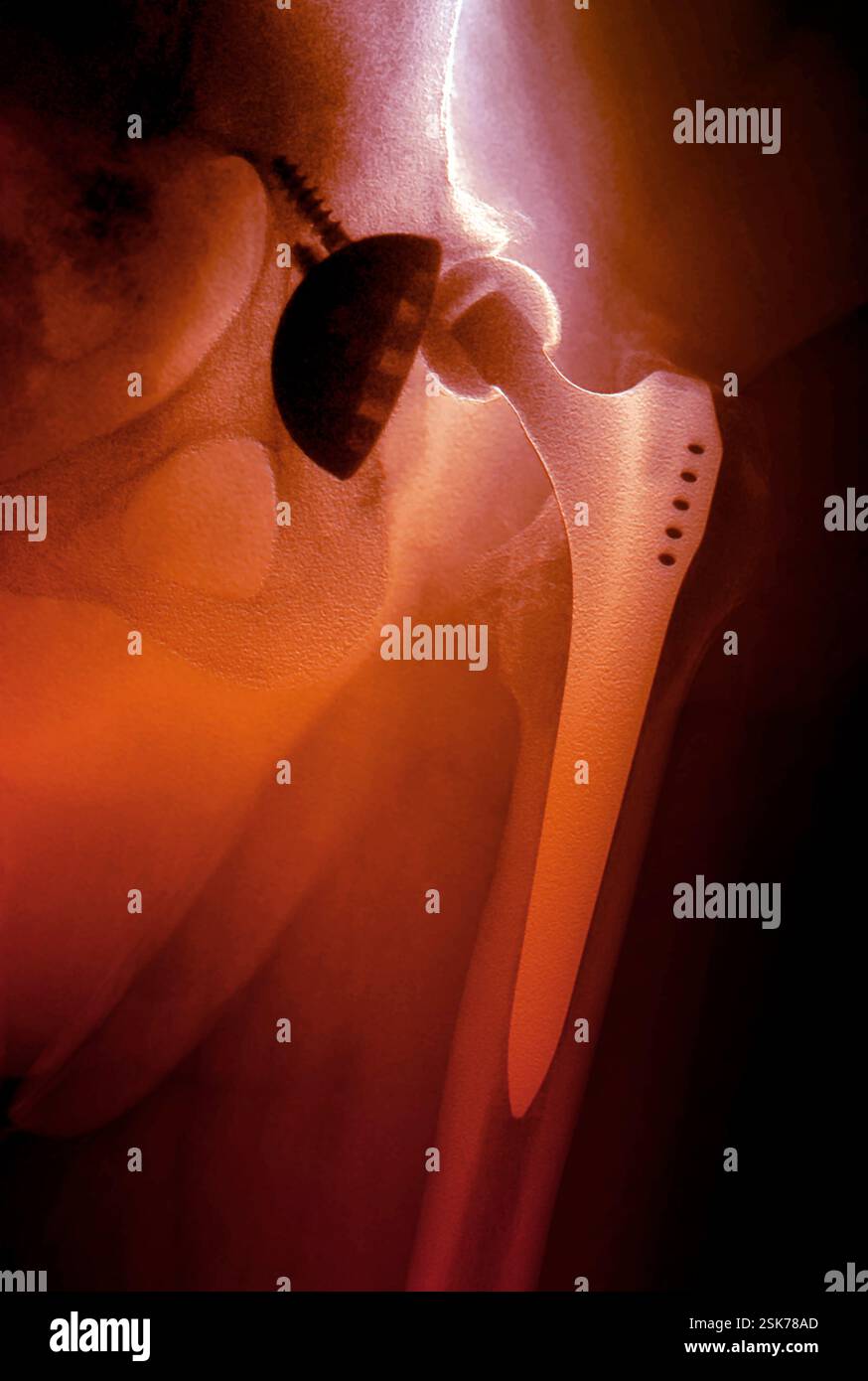 Coloured X-ray (front view) of the pelvis of a patient, showing ...