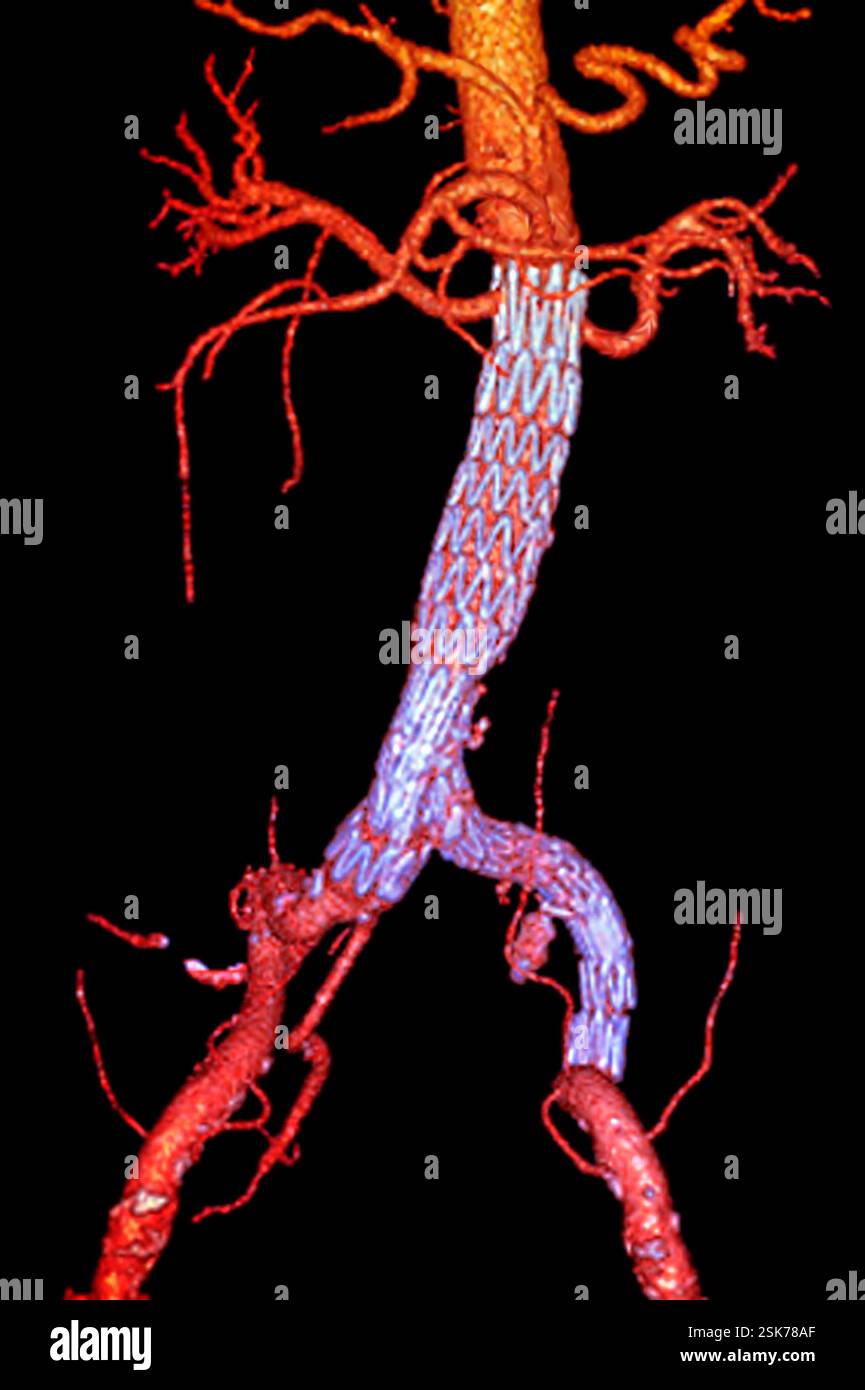 Coloured three-dimensional Computed Tomography (CT) angio scan of the ...