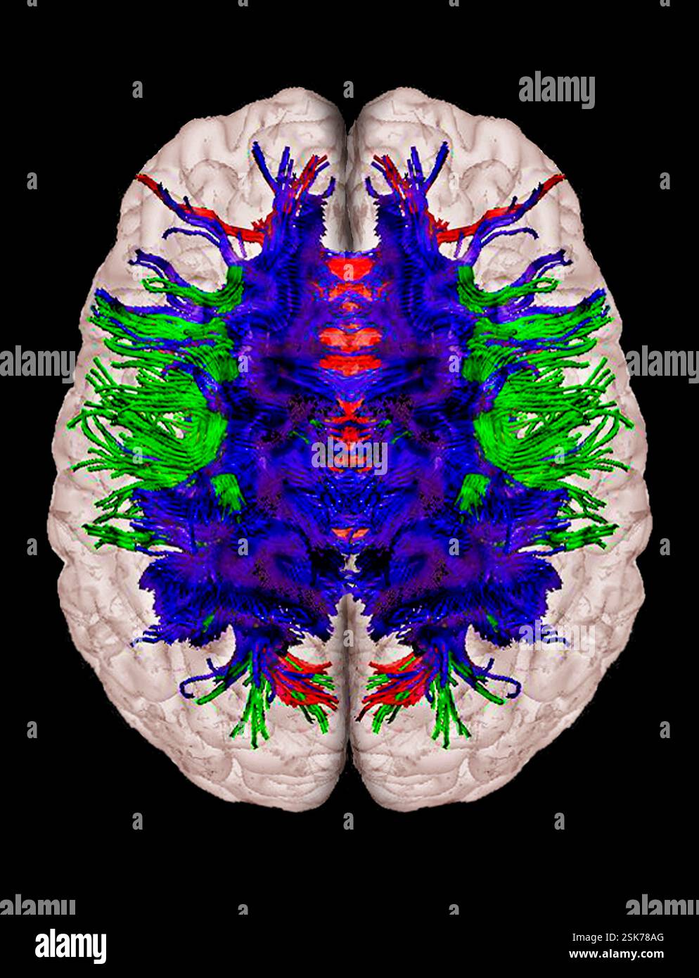Coloured Three Dimensional Diffusion Tensor Imaging Dti Scan In Top View Of The Brain Showing