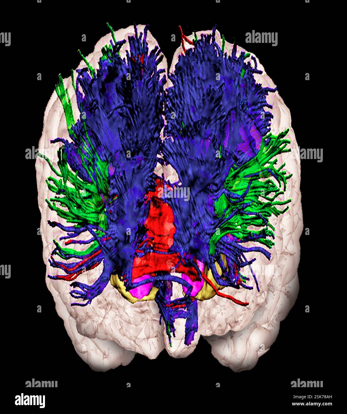 Coloured three-dimensional Diffusion Tensor Imaging (DTI) scan in coronal view through the brain ...
