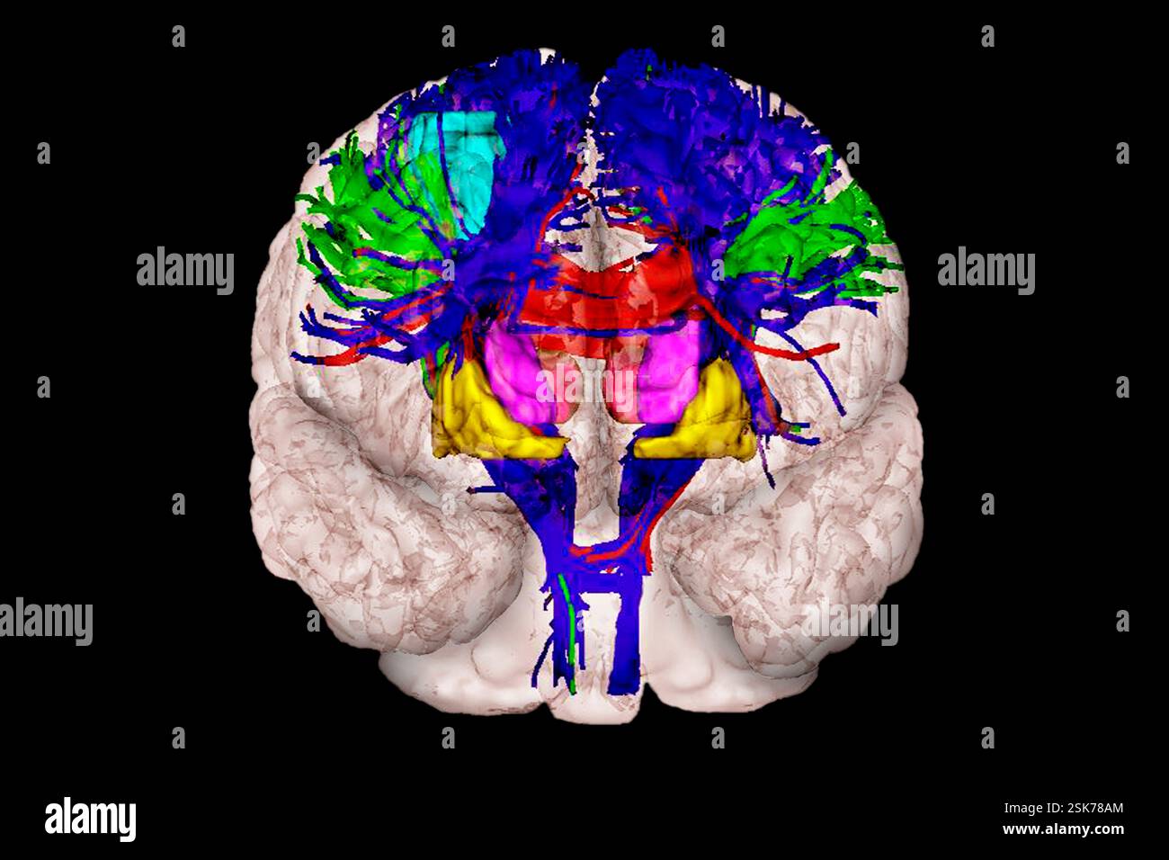 Coloured three-dimensional Diffusion Tensor Imaging (DTI) scan in coronal view through the brain ...