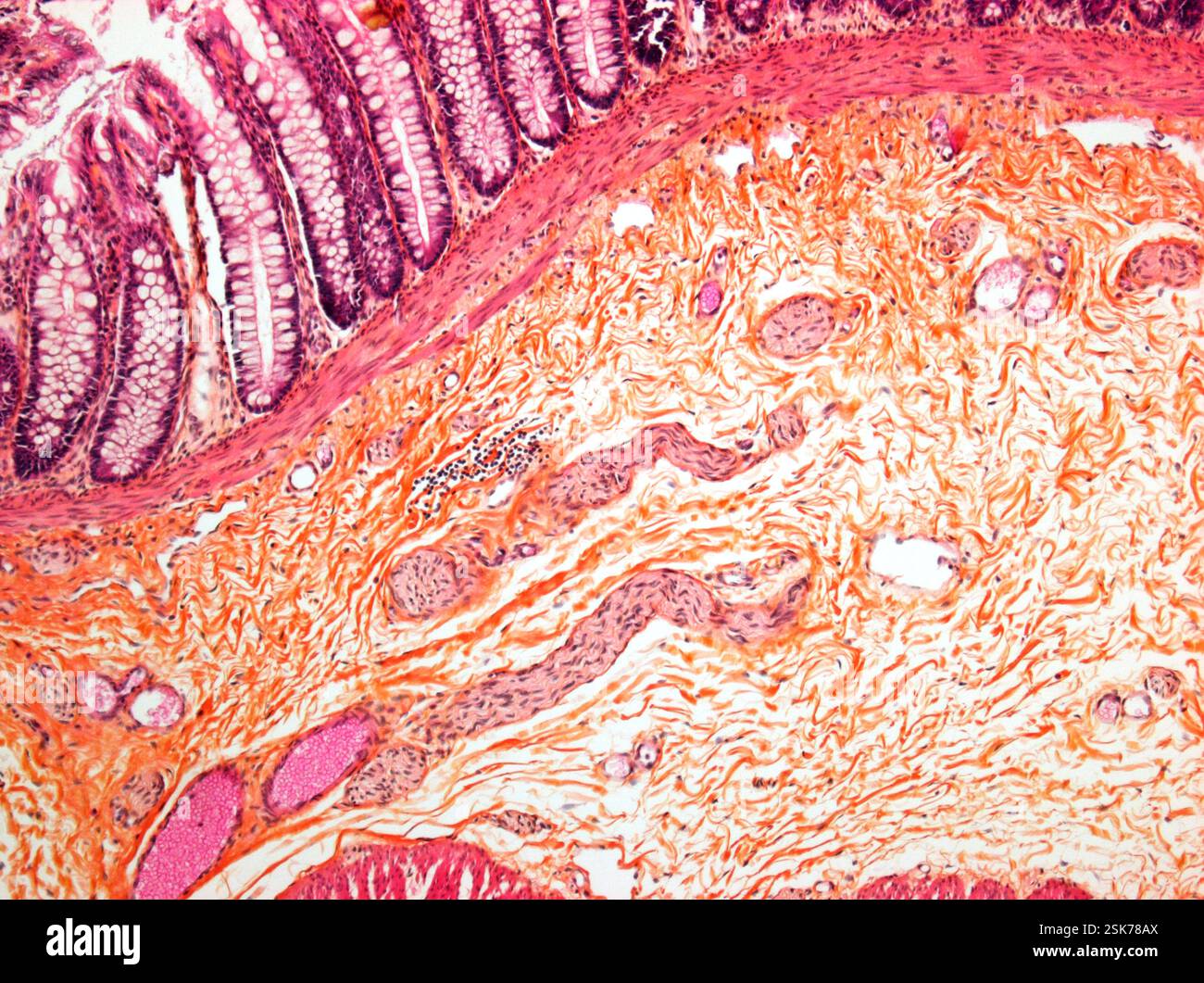 Light micrograph of a section through the enlarged wall of the large ...