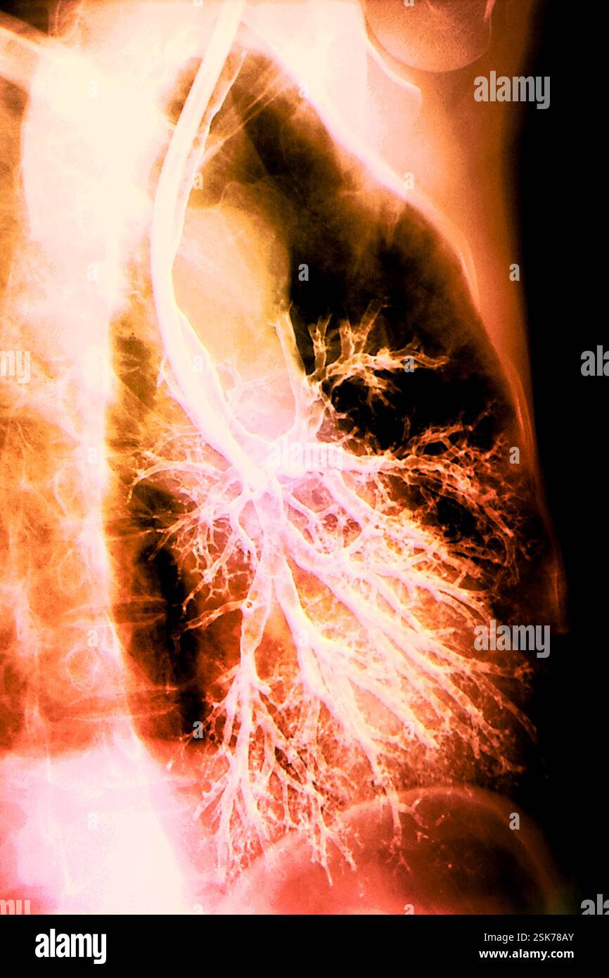 Coloured X-ray (bronchogram) in side view of the chest of a patient ...