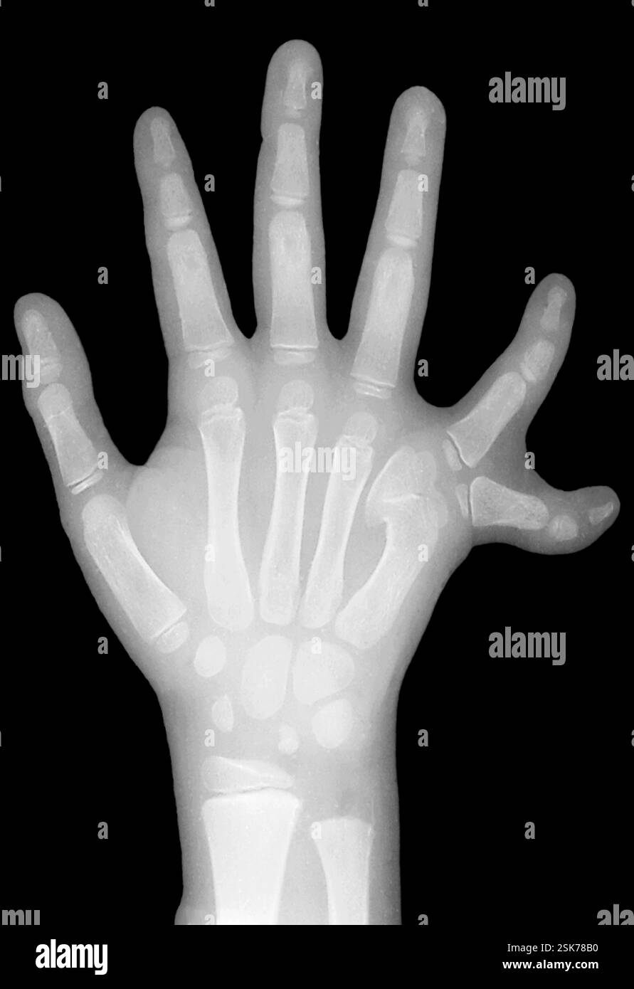 X-ray (front view) of the hand of a young child showing six fingers ...