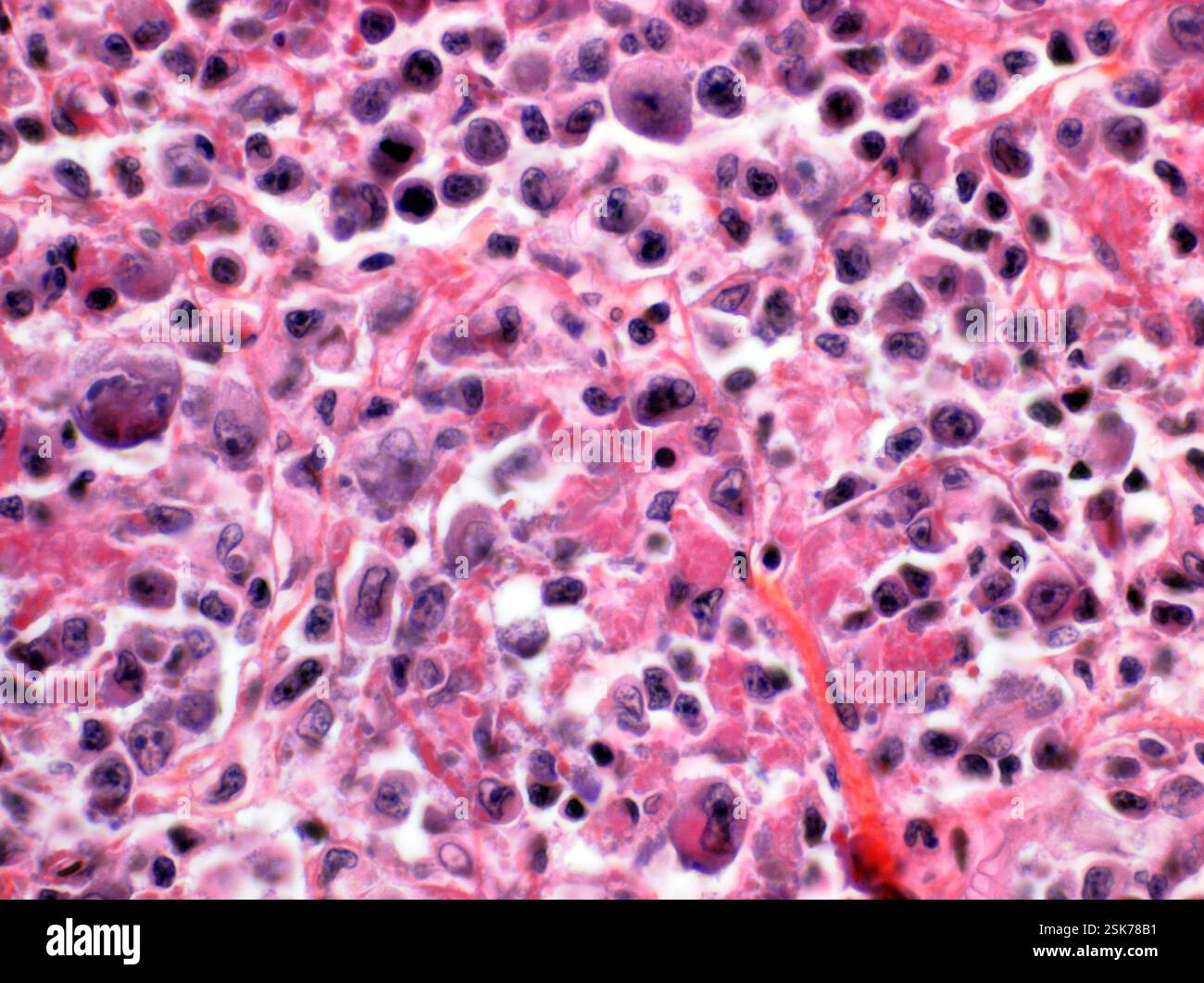 Light micrograph of a section through a swollen lymph gland ...