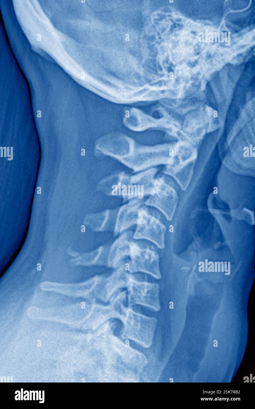 Coloured X-ray (side view) of the neck of a 36 year old female patient ...