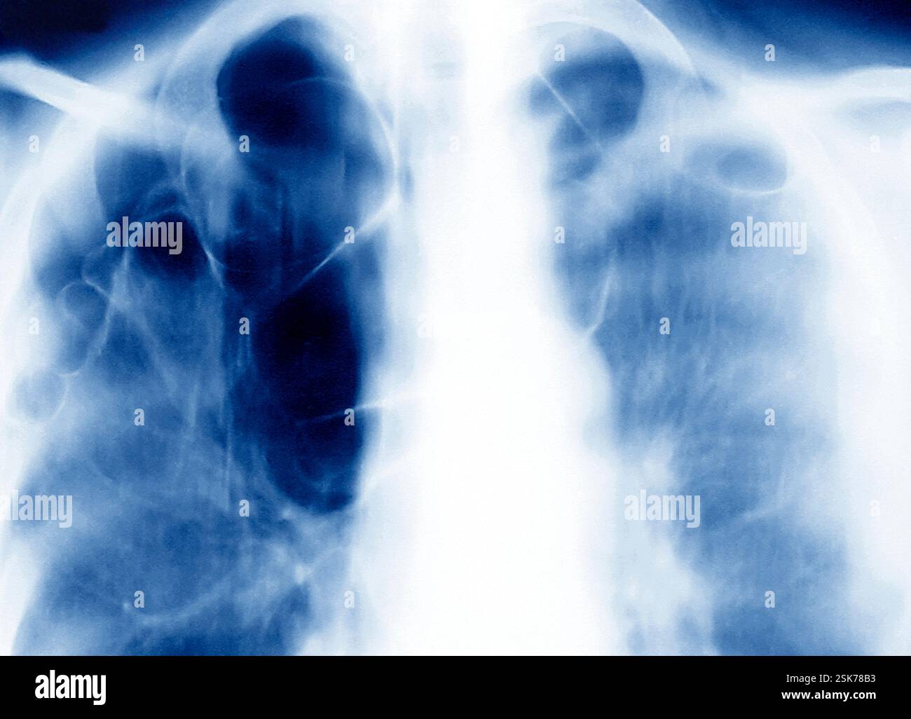 Coloured X-ray (front view) of the chest of a patient with pulmonary ...