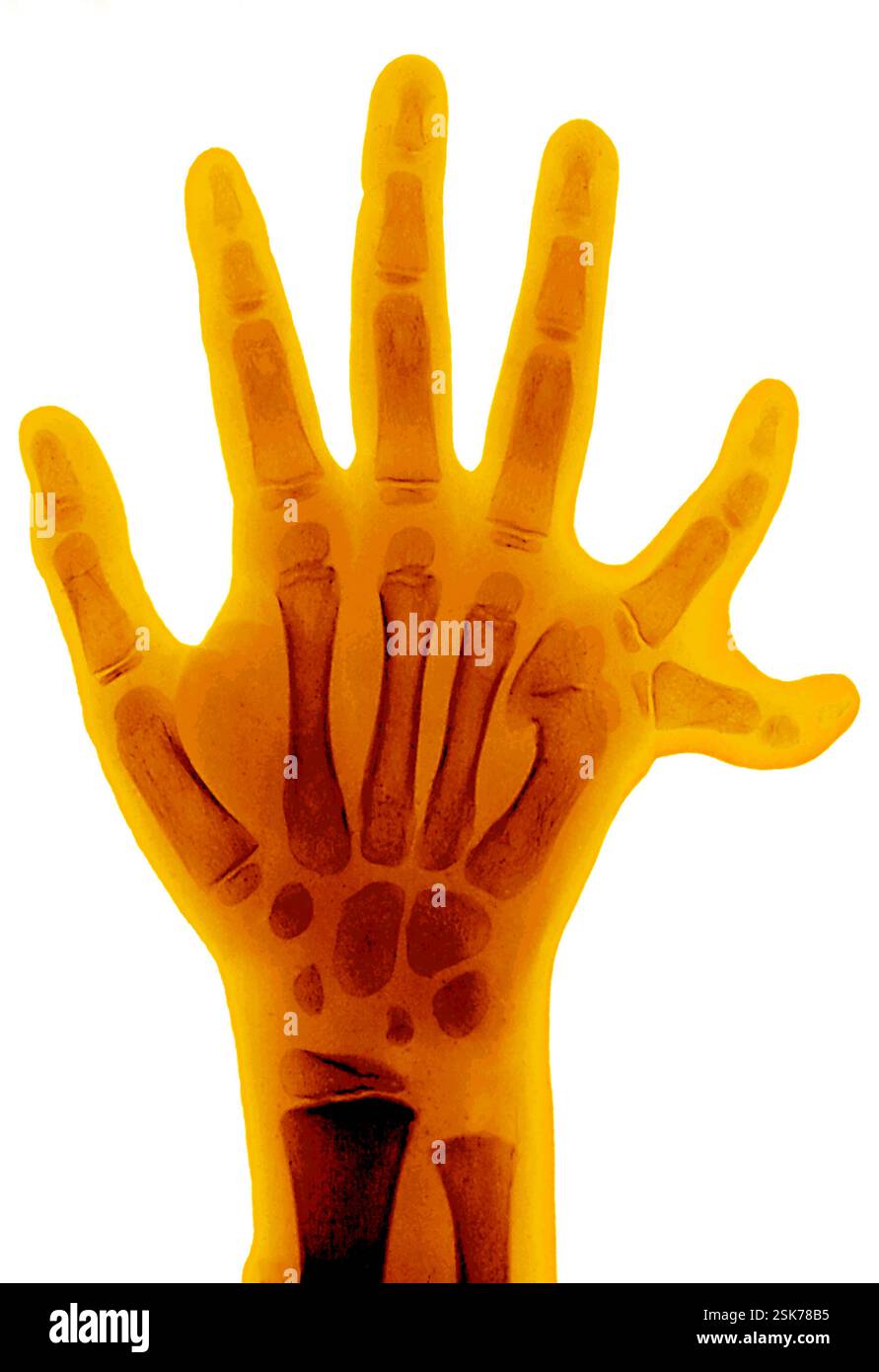 Coloured X-ray (front view) of the hand of a young child showing six ...