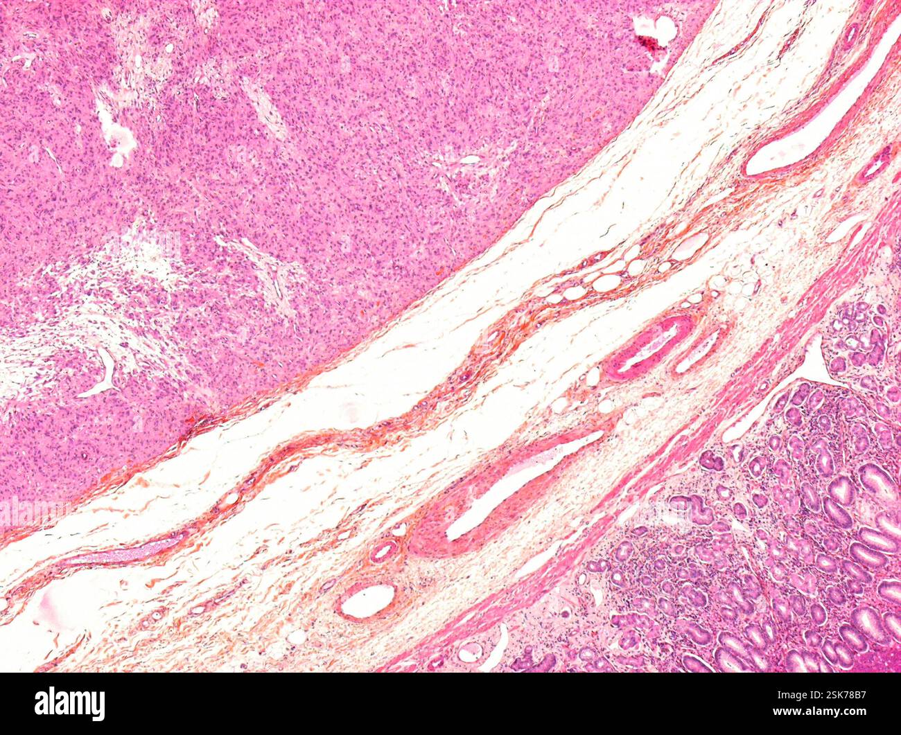 Light micrograph of a section through a gastrointestinal stromal tumour ...