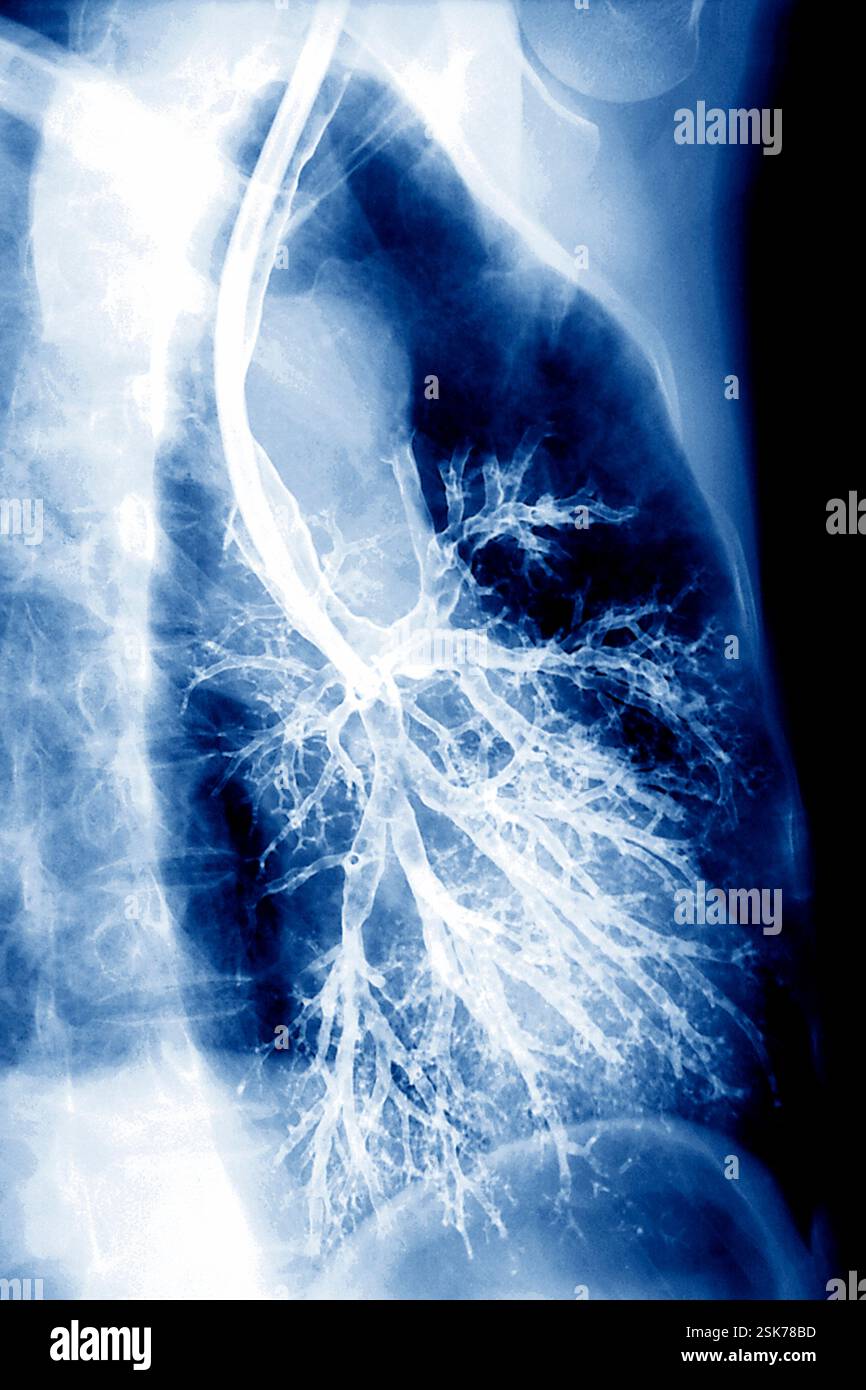 Coloured X-ray (bronchogram) in side view of the chest of a patient ...