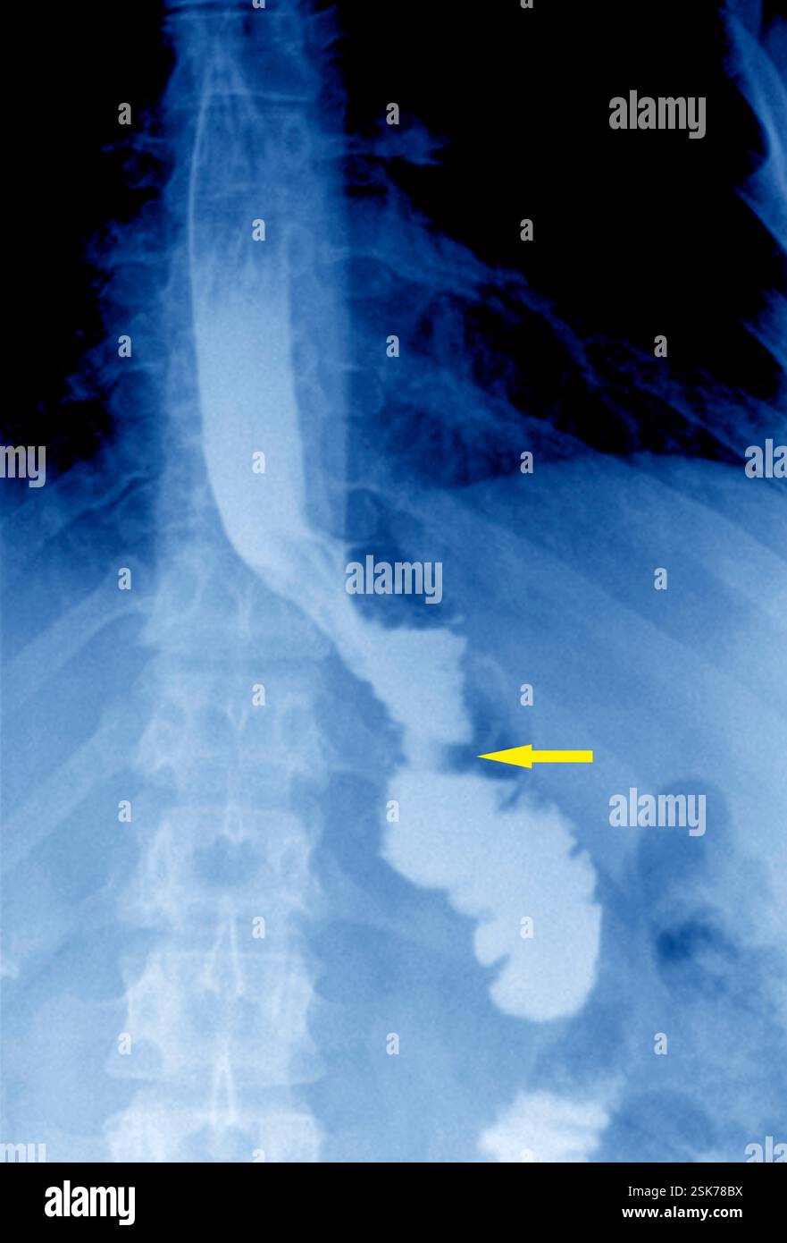 Coloured X-ray (front view) of the upper gastroduodenal tract of a 26 ...