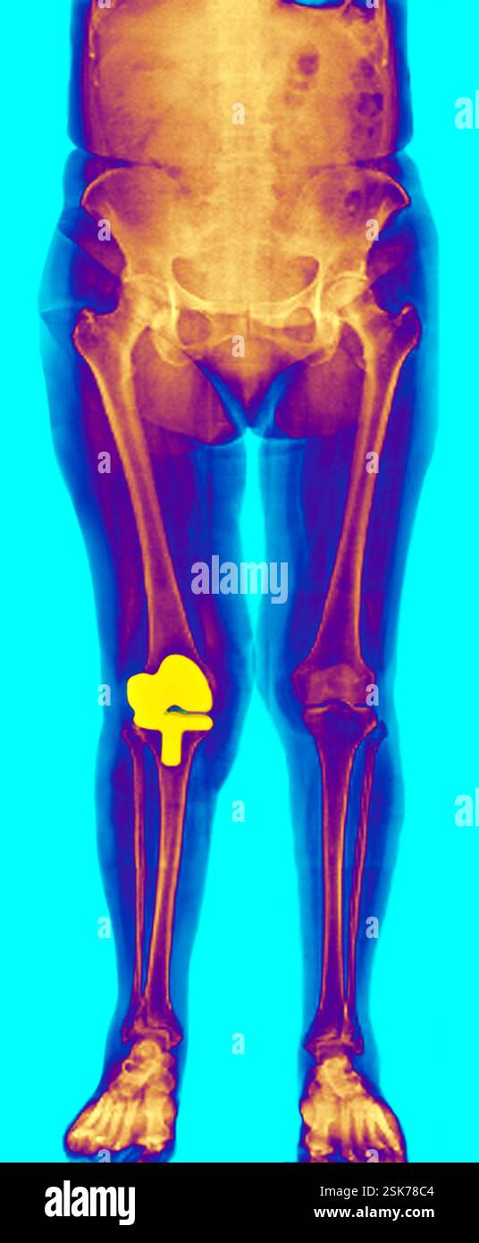 Coloured X-ray (front view) of the legs of a 58 year old female patient ...