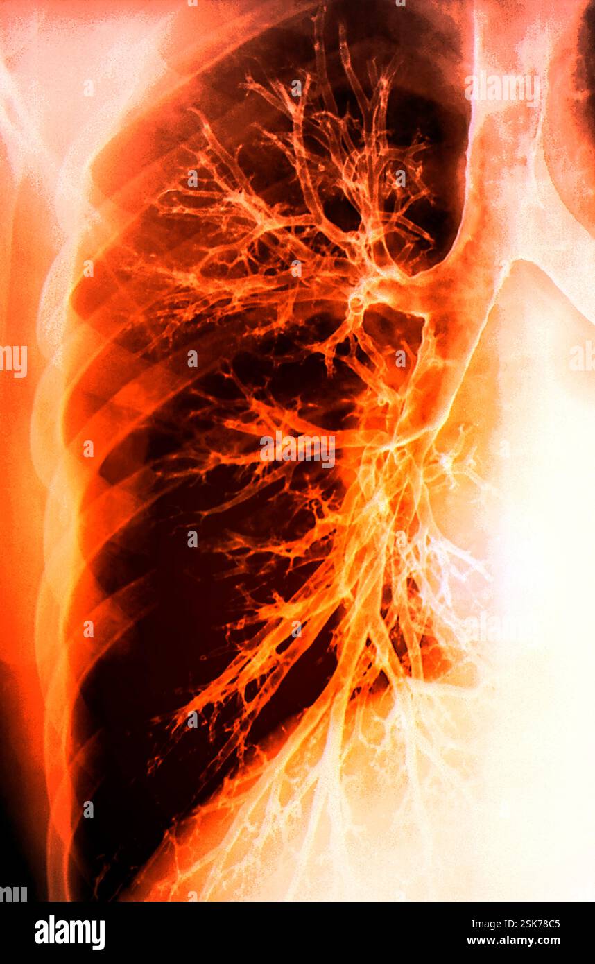 Coloured X-ray (bronchogram) in side view of the chest of a patient ...