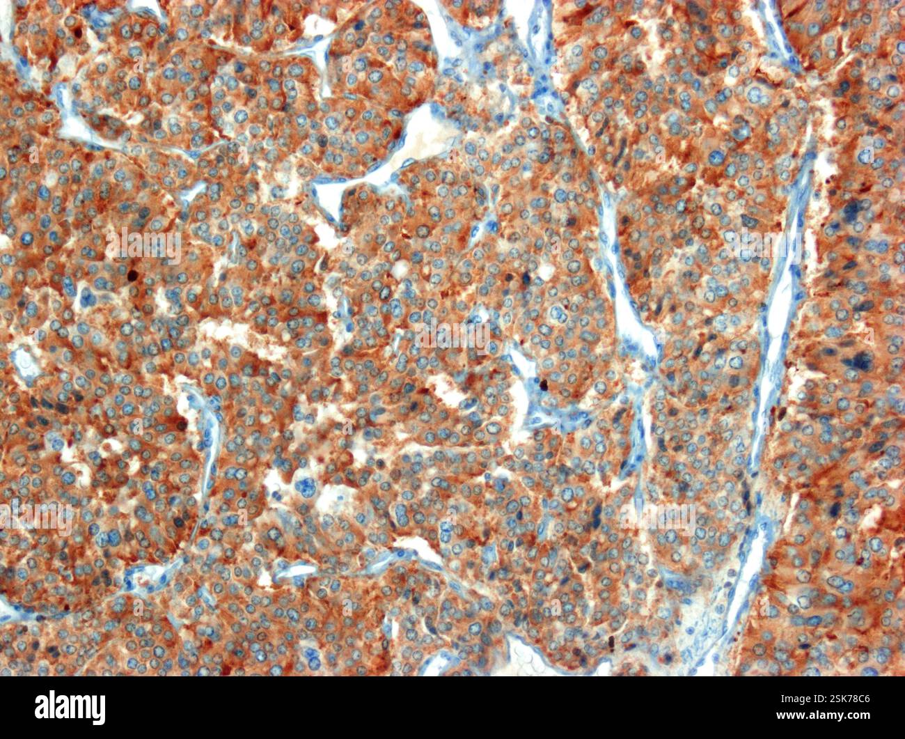 Light micrograph of a section through a pheochromocytoma tumour of the ...