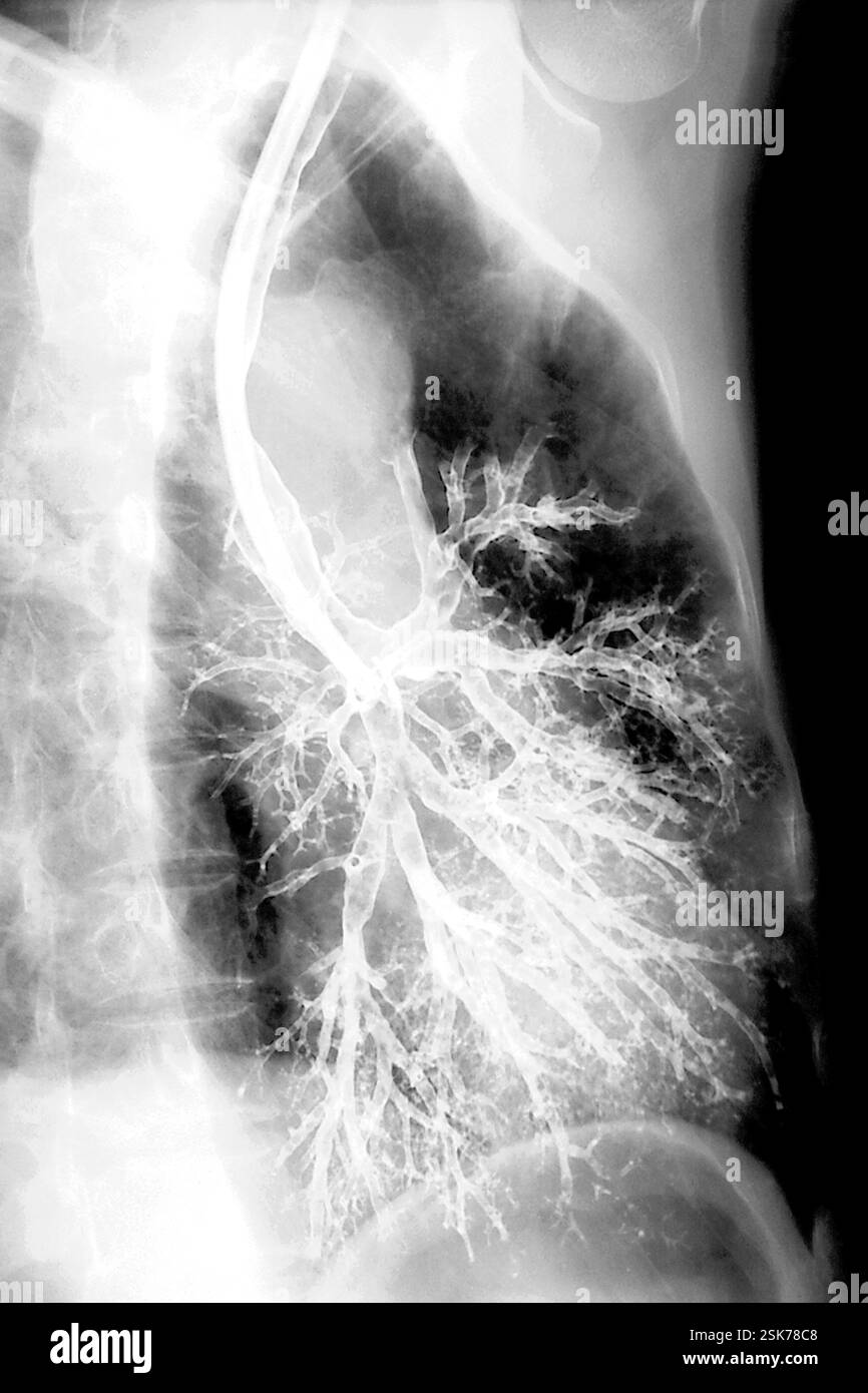 X-ray (bronchogram) in side view of the chest of a patient showing a ...