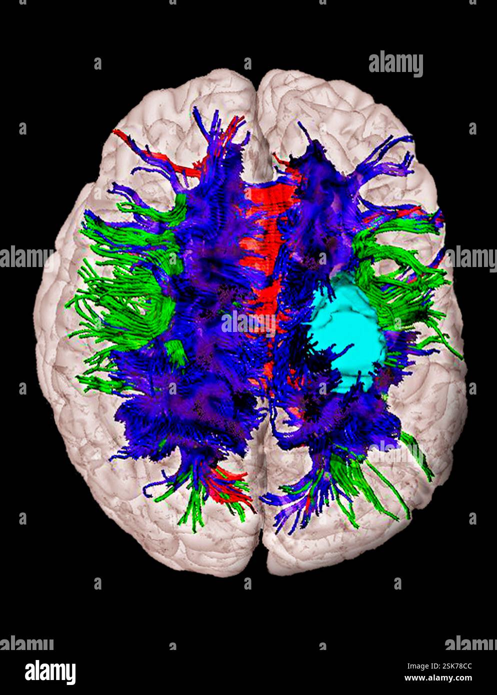 Coloured three-dimensional Diffusion Tensor Imaging (DTI) scan in top view through the brain ...