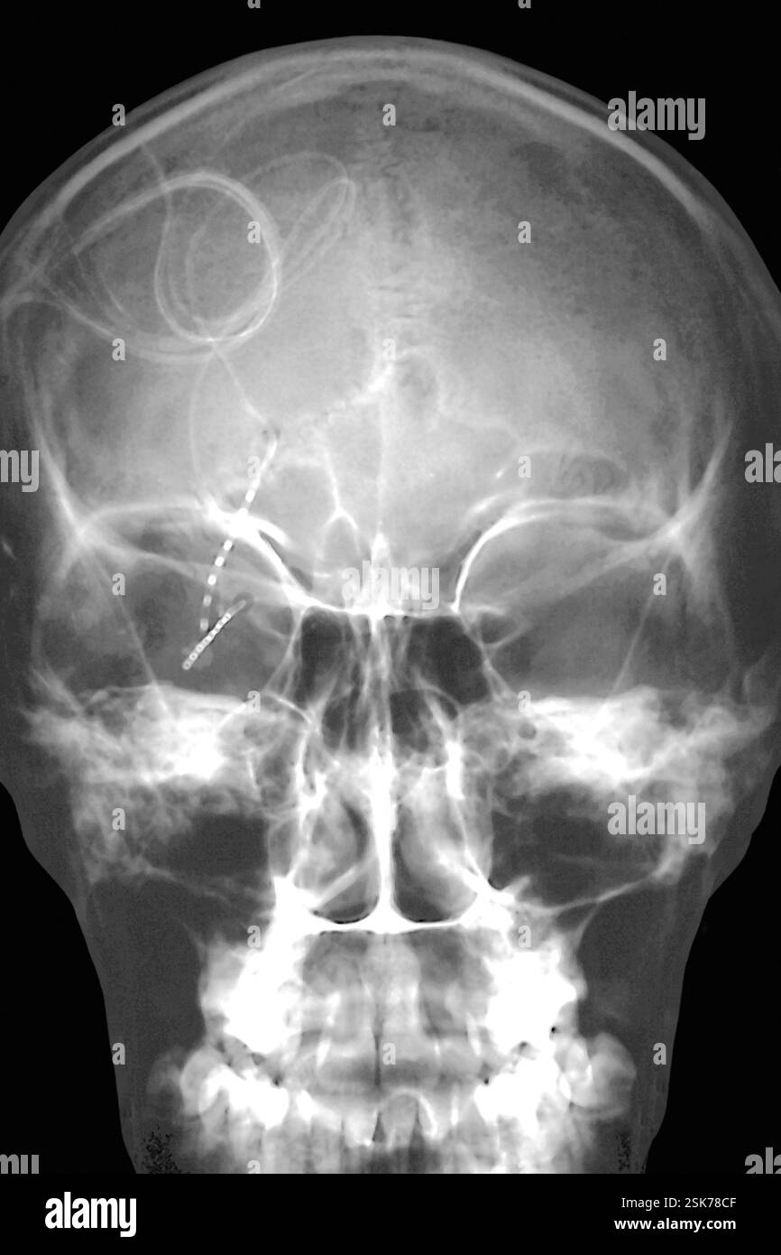 X-ray (front view) of the skull of a patient with epilepsy, showing ...
