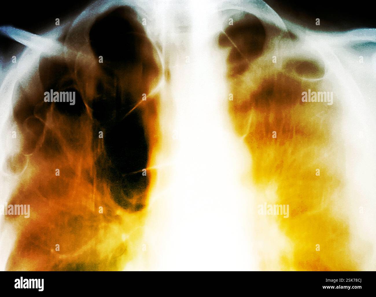 Coloured X-ray (front view) of the chest of a patient with pulmonary ...
