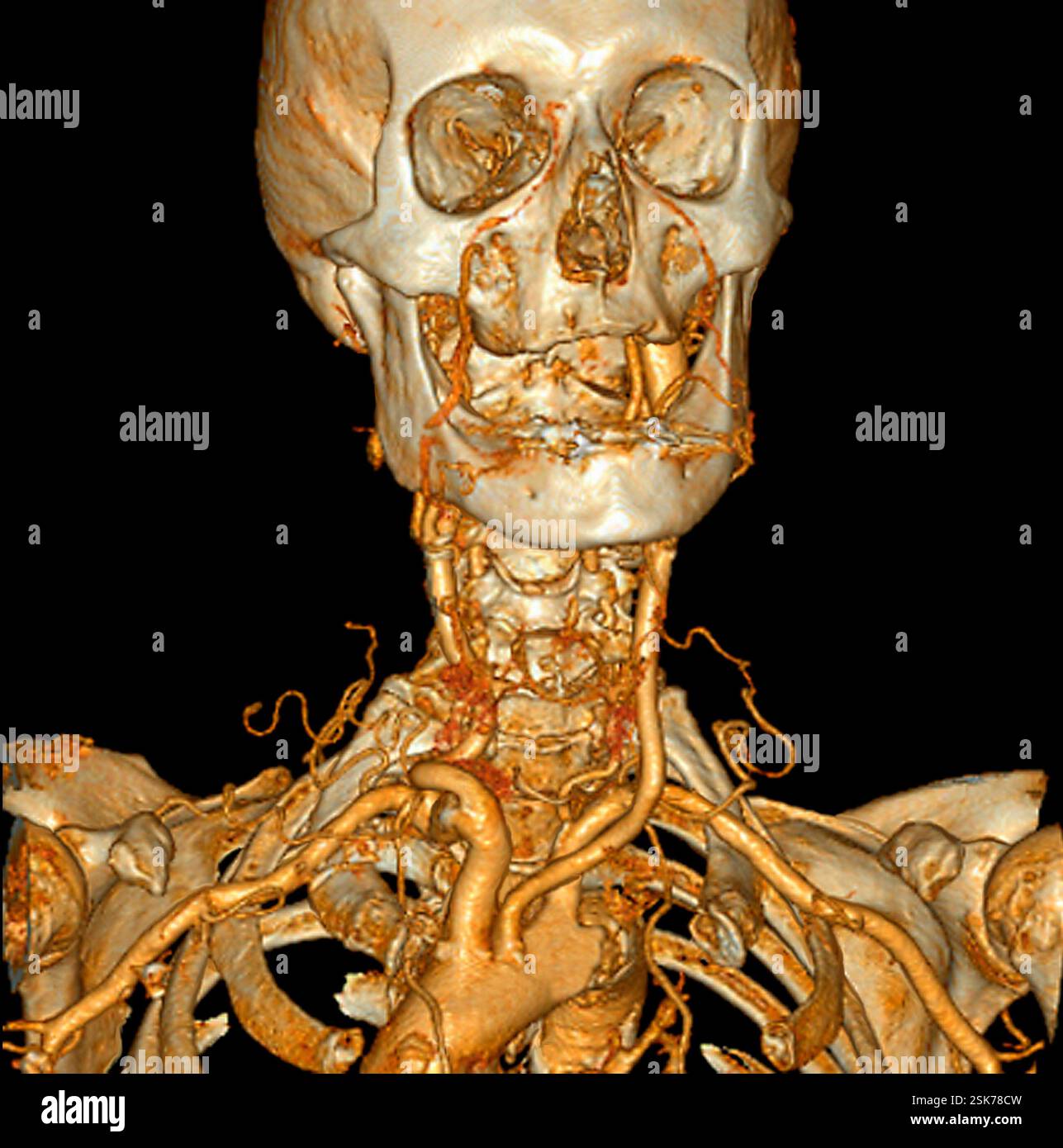 Coloured three-dimensional (3D) Angiography Computed Tomography (CT) scan in front view of the ...