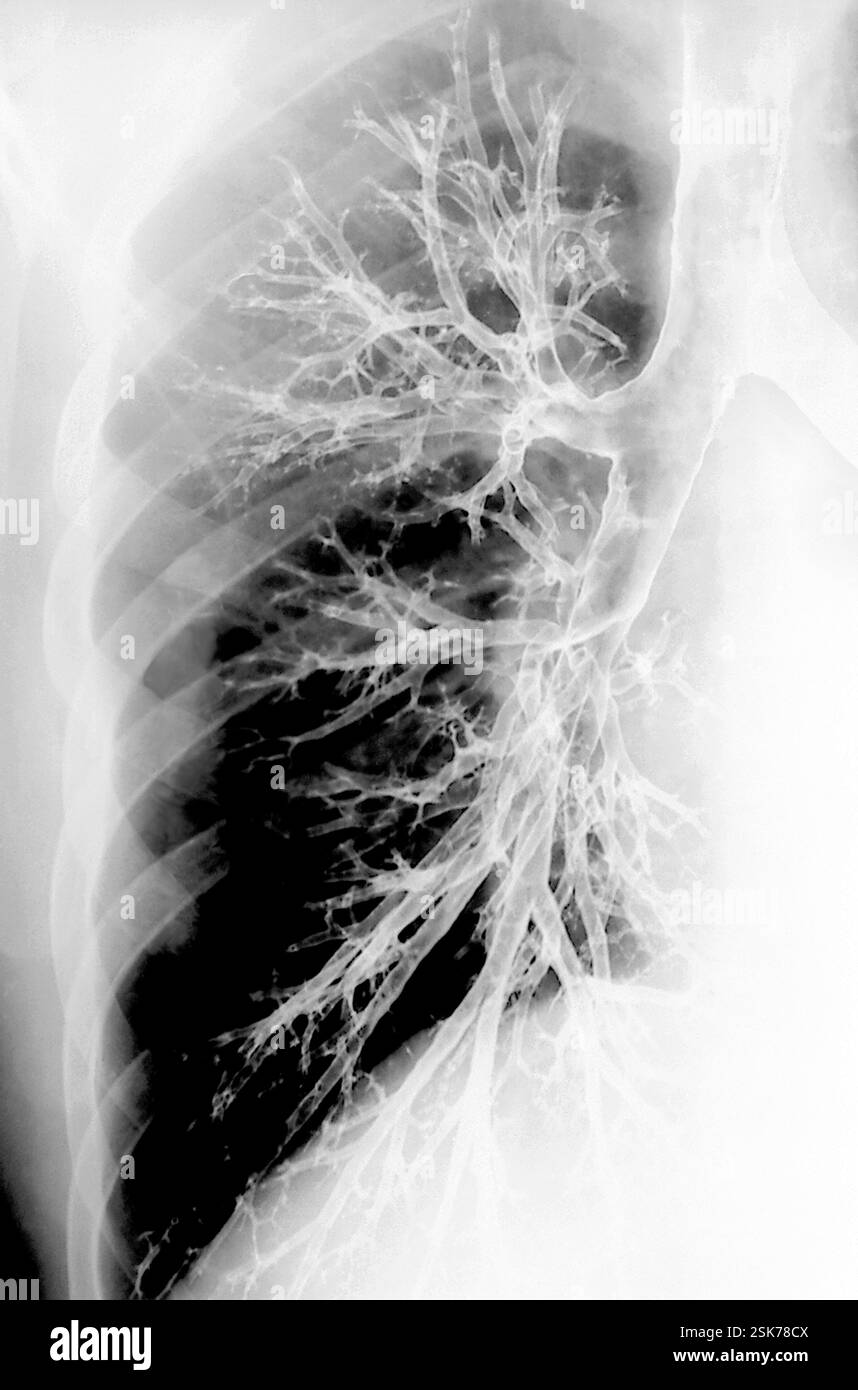 X-ray (bronchogram) in side view of the chest of a patient showing a ...