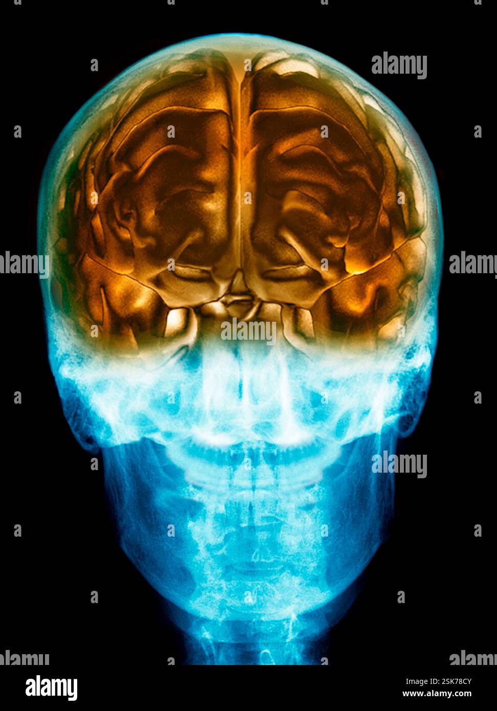 Coloured three-dimensional (3D) Magnetic Resonance Imaging (MRI) scan in front view of a healthy ...