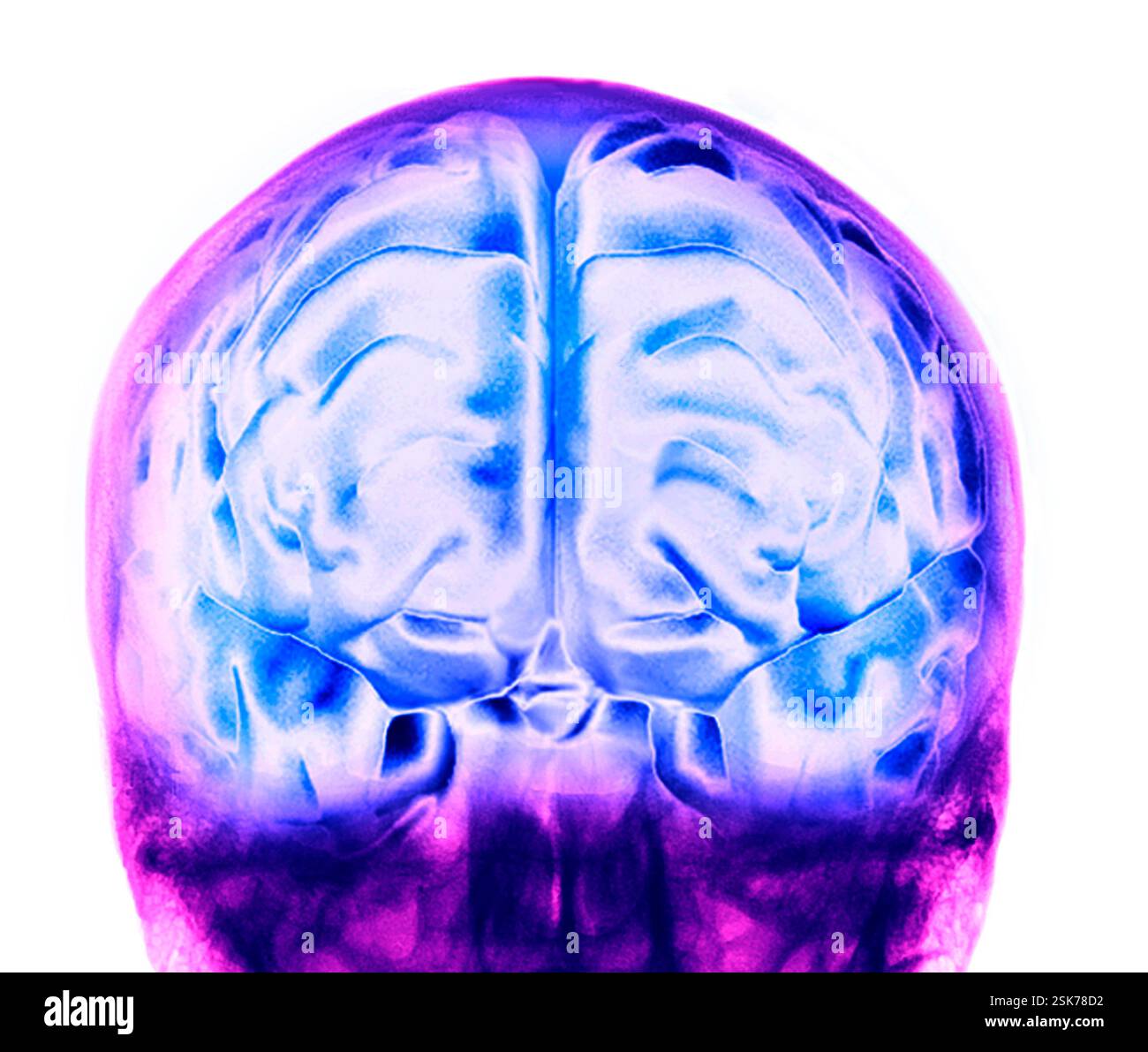 Coloured three-dimensional (3D) Magnetic Resonance Imaging (MRI) scan ...