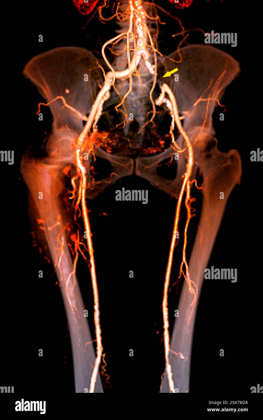 Coloured three-dimensional (3D) Angiography Computed Tomography (CT) scan in front view of ...