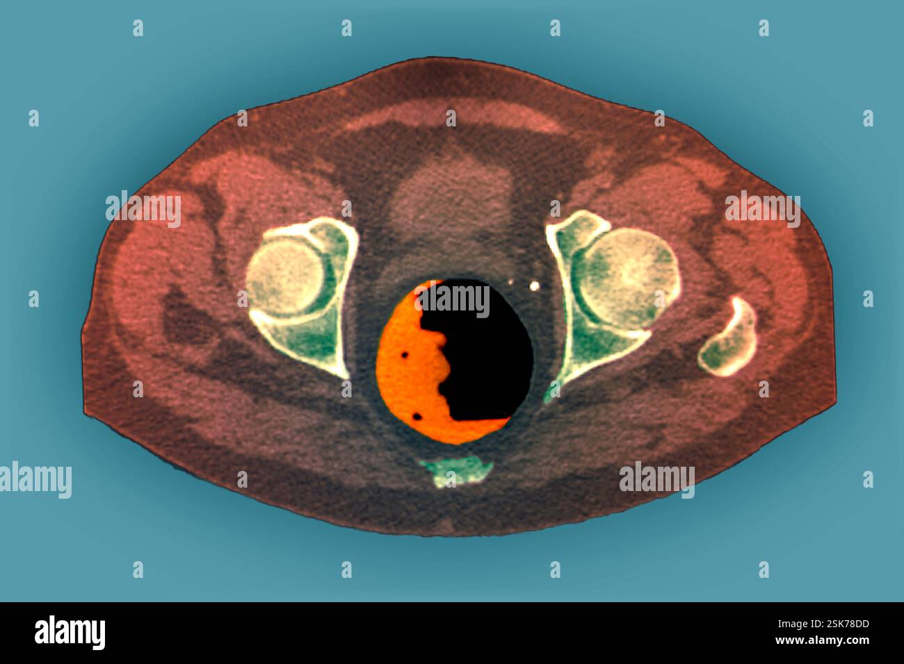 Coloured computed tomography (CT) scan in axial section through the lower abdomen of a 75 year ...