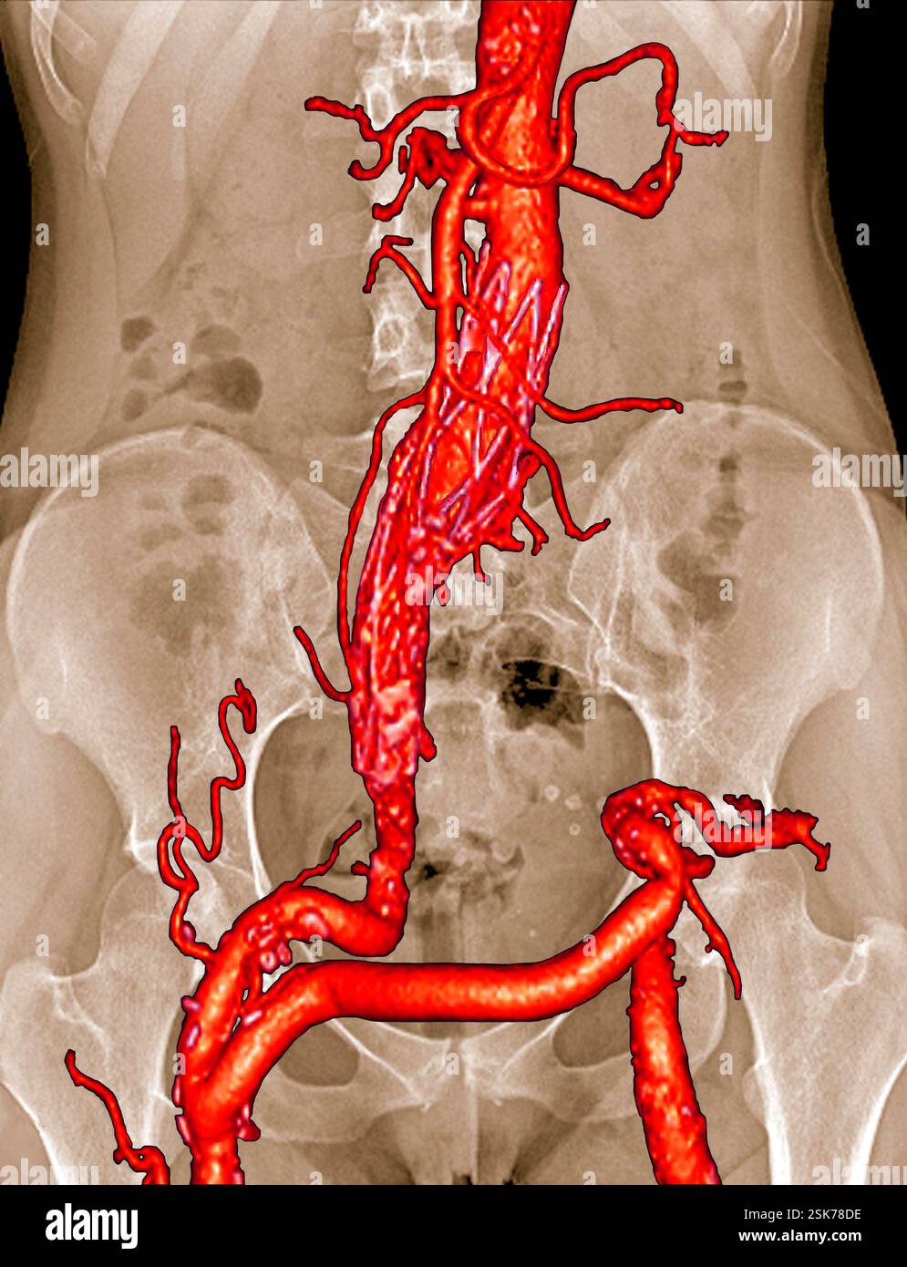 Coloured three-dimensional (3D) Angiography Computed Tomography (CT) scan in front view of the ...