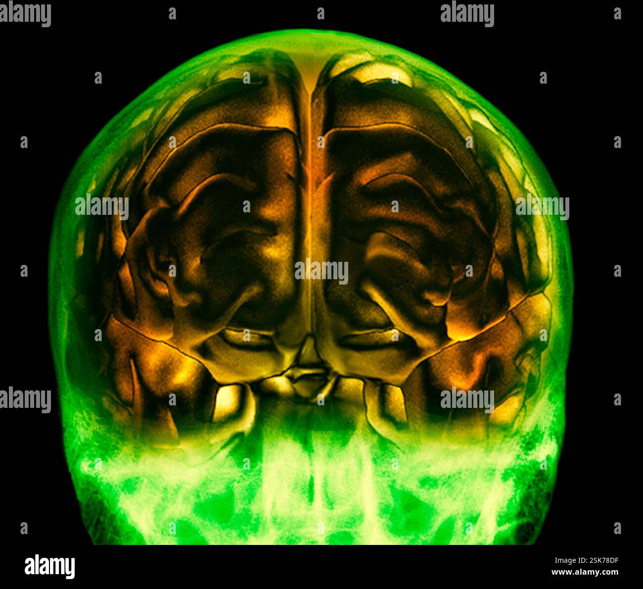 Coloured three-dimensional (3D) Magnetic Resonance Imaging (MRI) scan in front view of a healthy ...