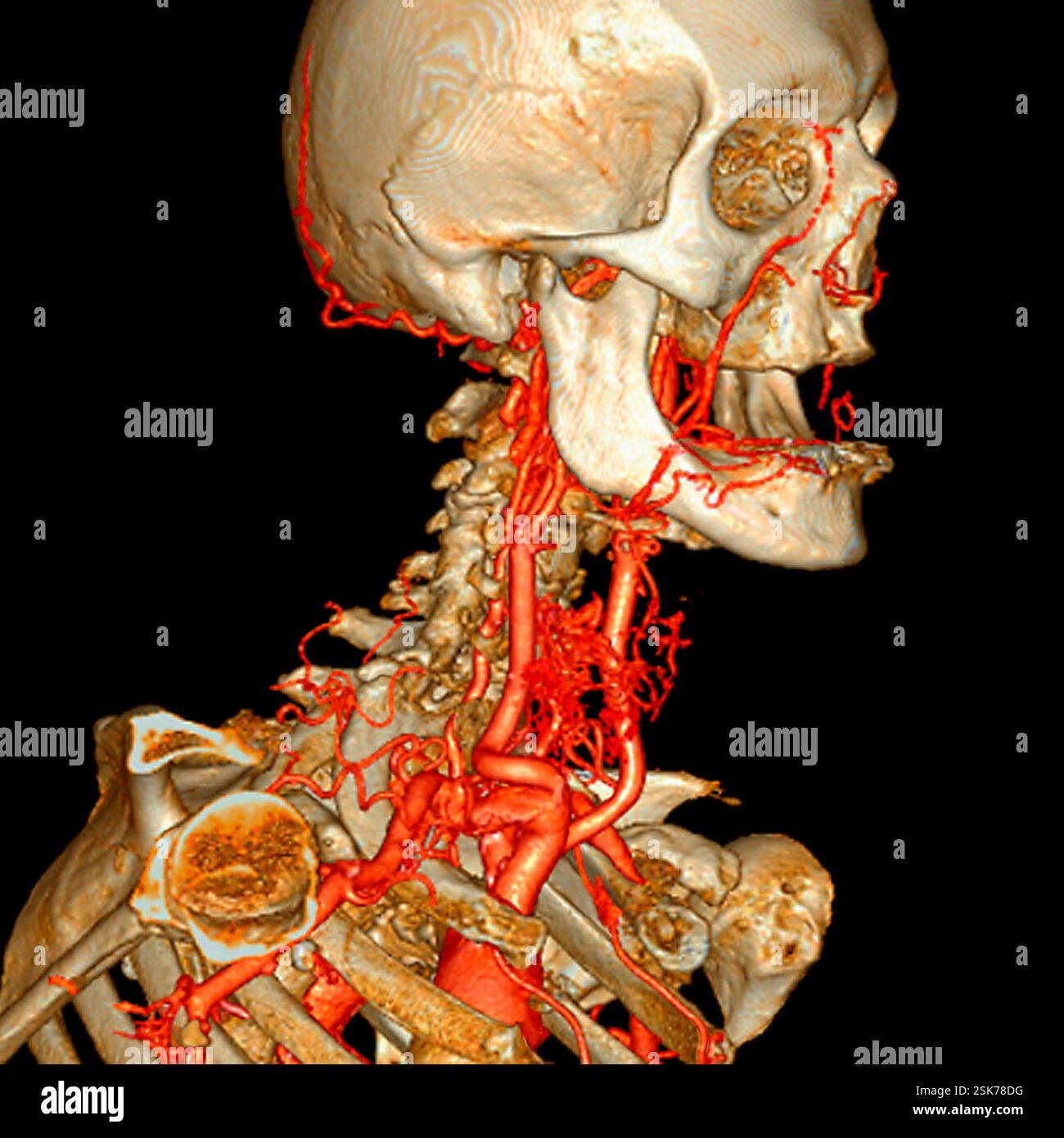 Coloured three-dimensional (3D) Angiography Computed Tomography (CT) scan in side view of the ...