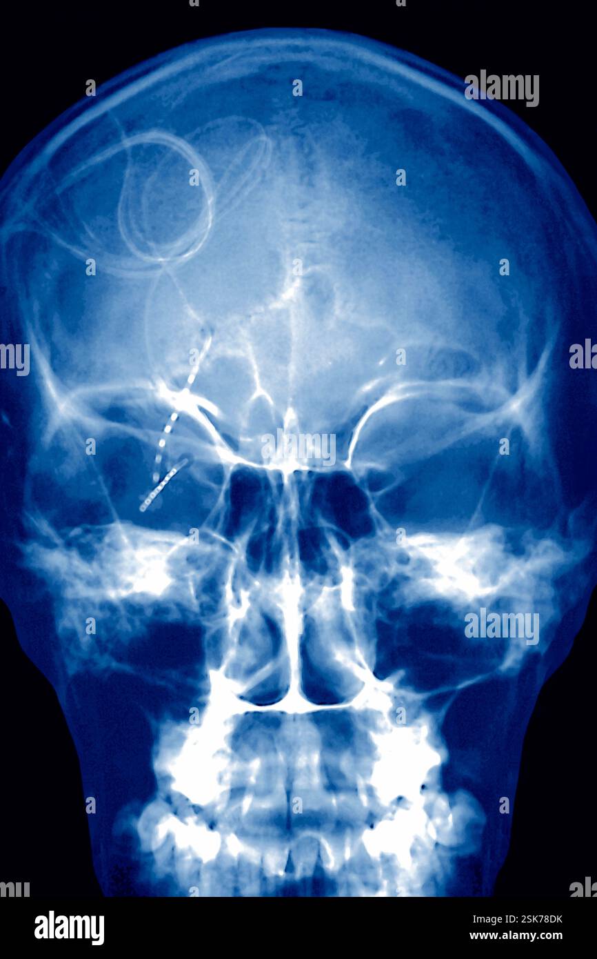 Coloured X-ray (front view) of the skull of a patient with epilepsy ...