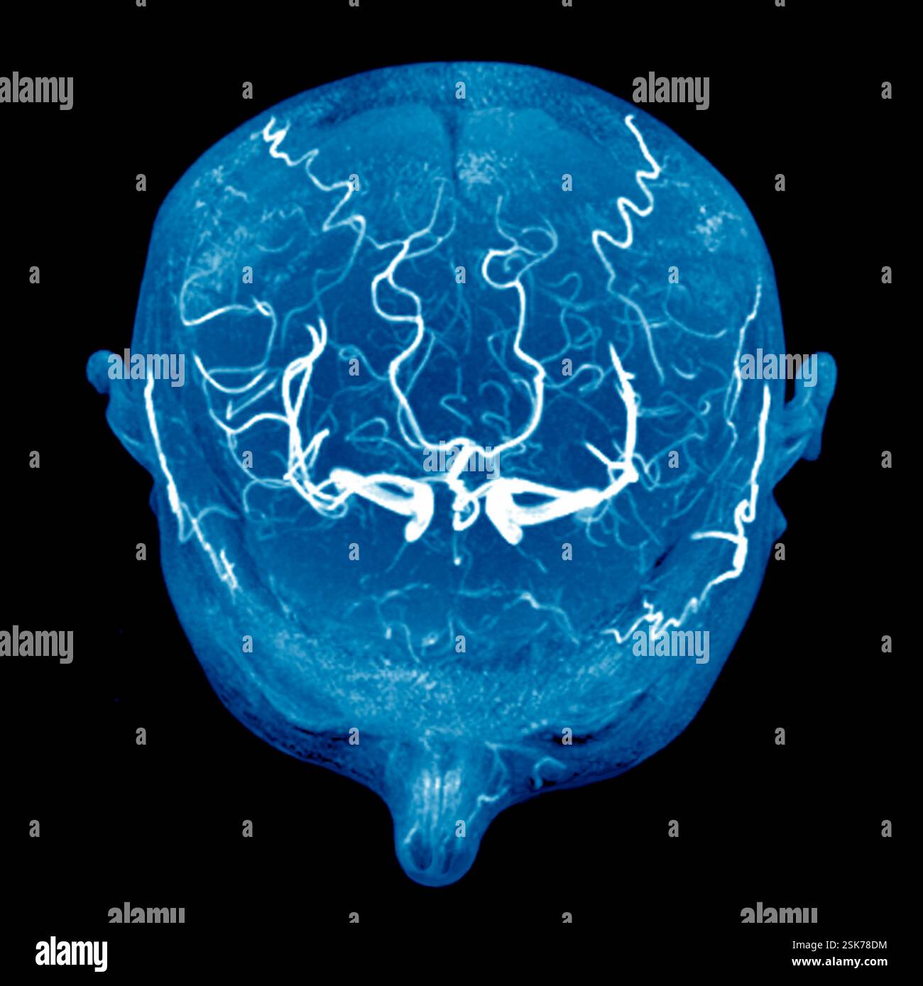Coloured three-dimensional (3D) Magnetic Resonance Imaging (MRI) scan in top view of healthy ...