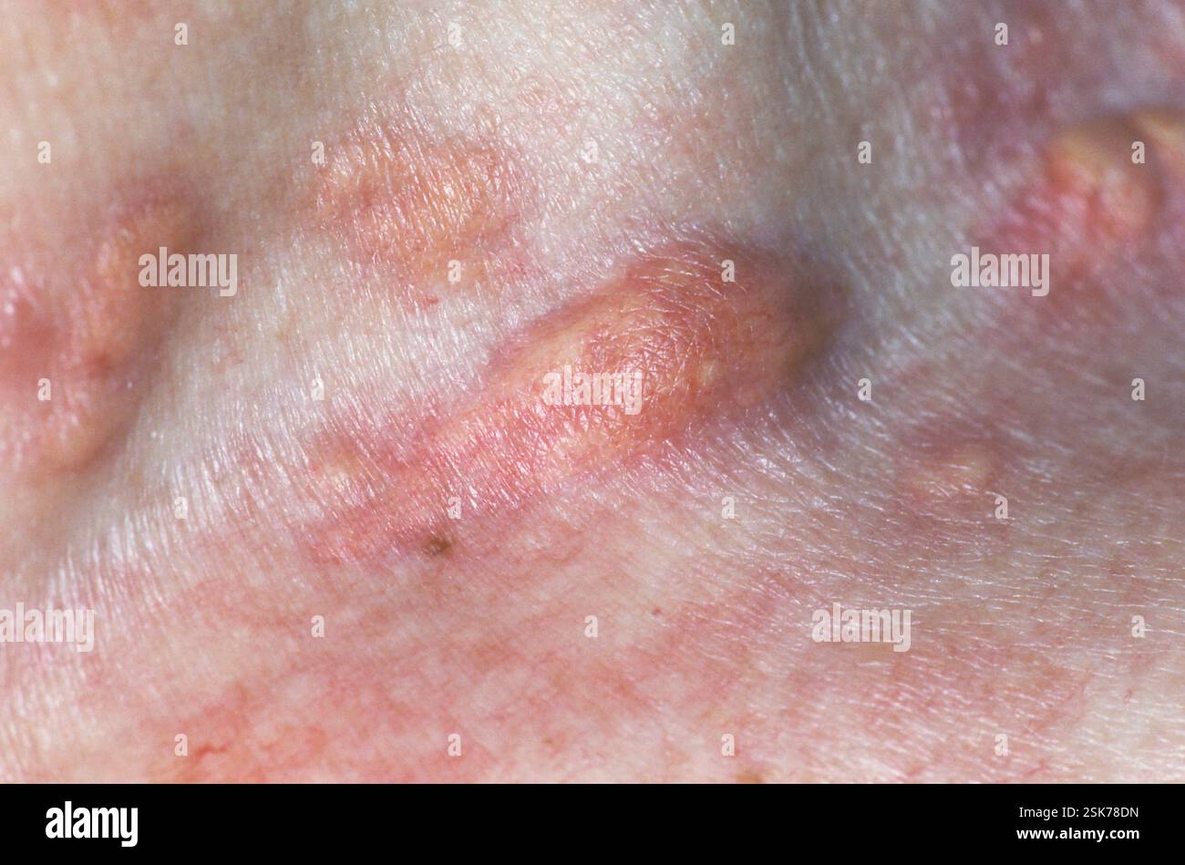 Close-up of bullous disease (nodules) of the neck in a male patient of ...