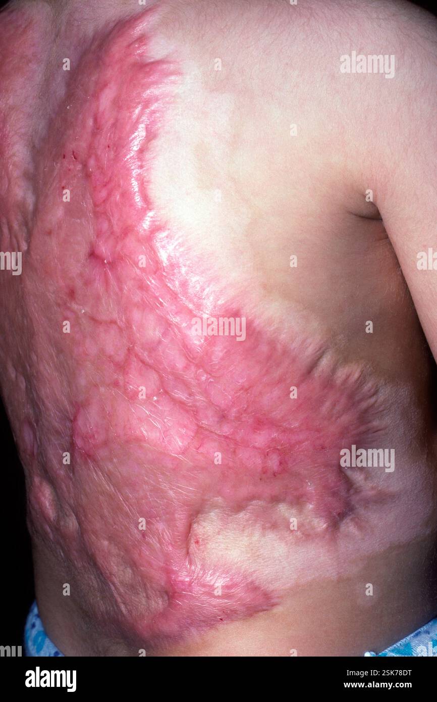Keloid scarring on the skin of the back in a male patient after burns ...