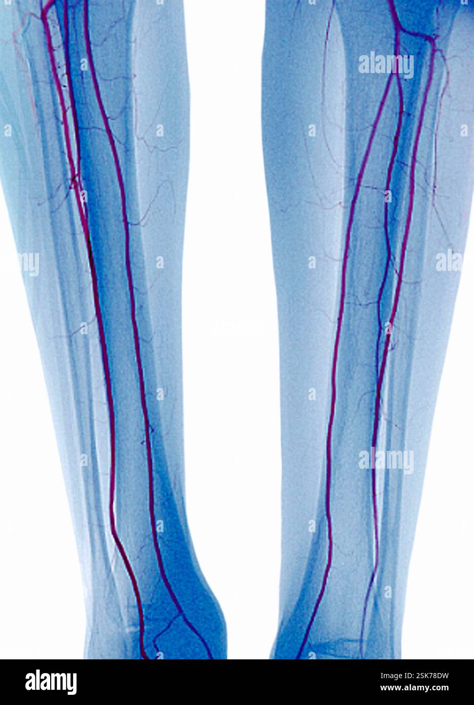 Coloured digital angiogram (X-ray) in front view of the lower limbs in ...