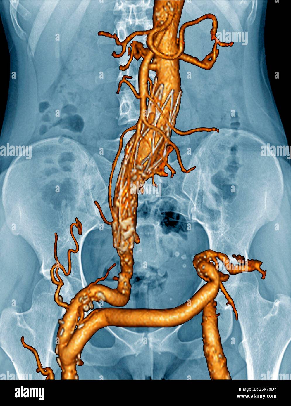Coloured three-dimensional (3D) Angiography Computed Tomography (CT) scan in front view of the ...