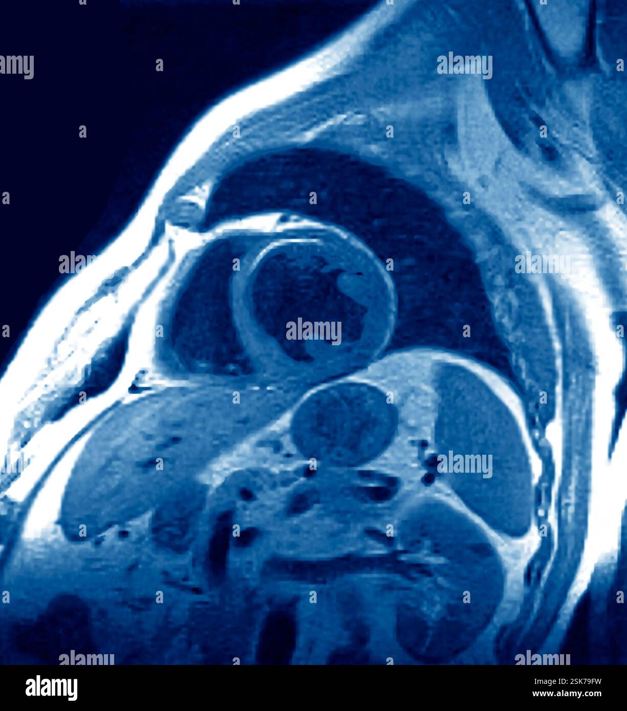 Heart disease. Coloured magnetic resonance imaging (MRI) scan of a ...