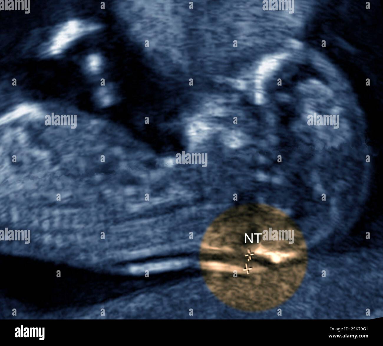 Obstetrical ultrasound scan (sagittal view) of a foetus at 13 weeks and ...