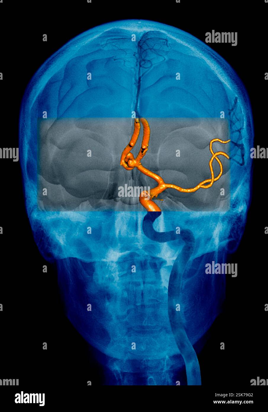 Coloured three-dimensional (3D) Angiography Computed Tomography (CT) scan in front view of a ...