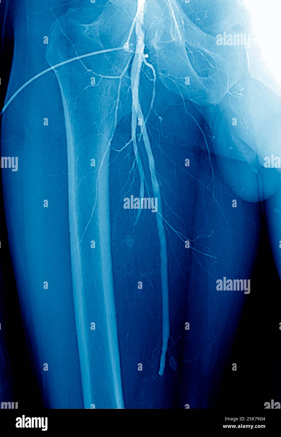 Coloured digital angiogram (X-ray) in front view of the lower limb in a ...