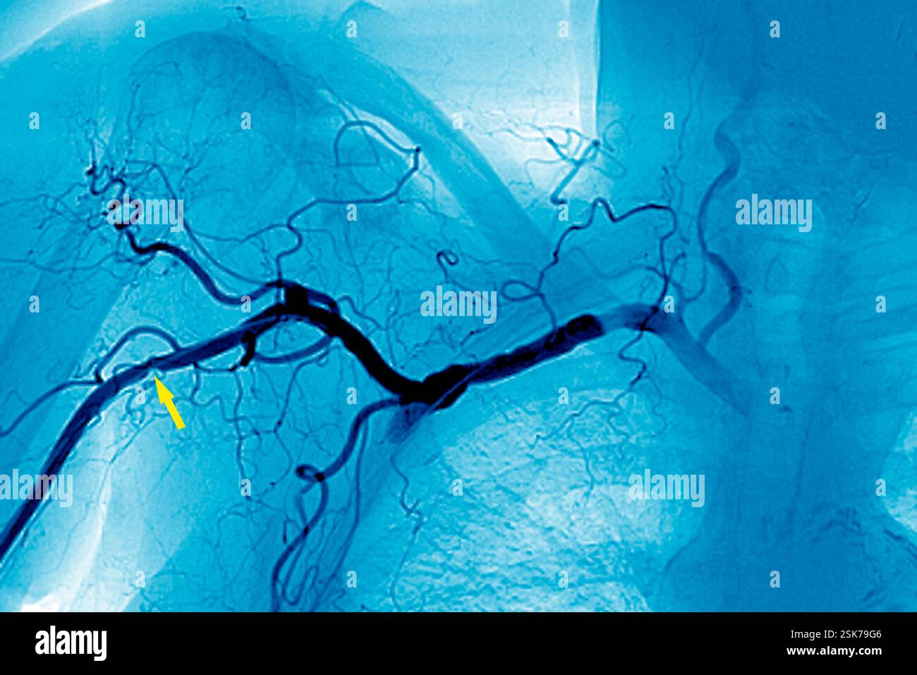 Coloured digital angiogram (X-ray) of the humerus-axillary artery ...