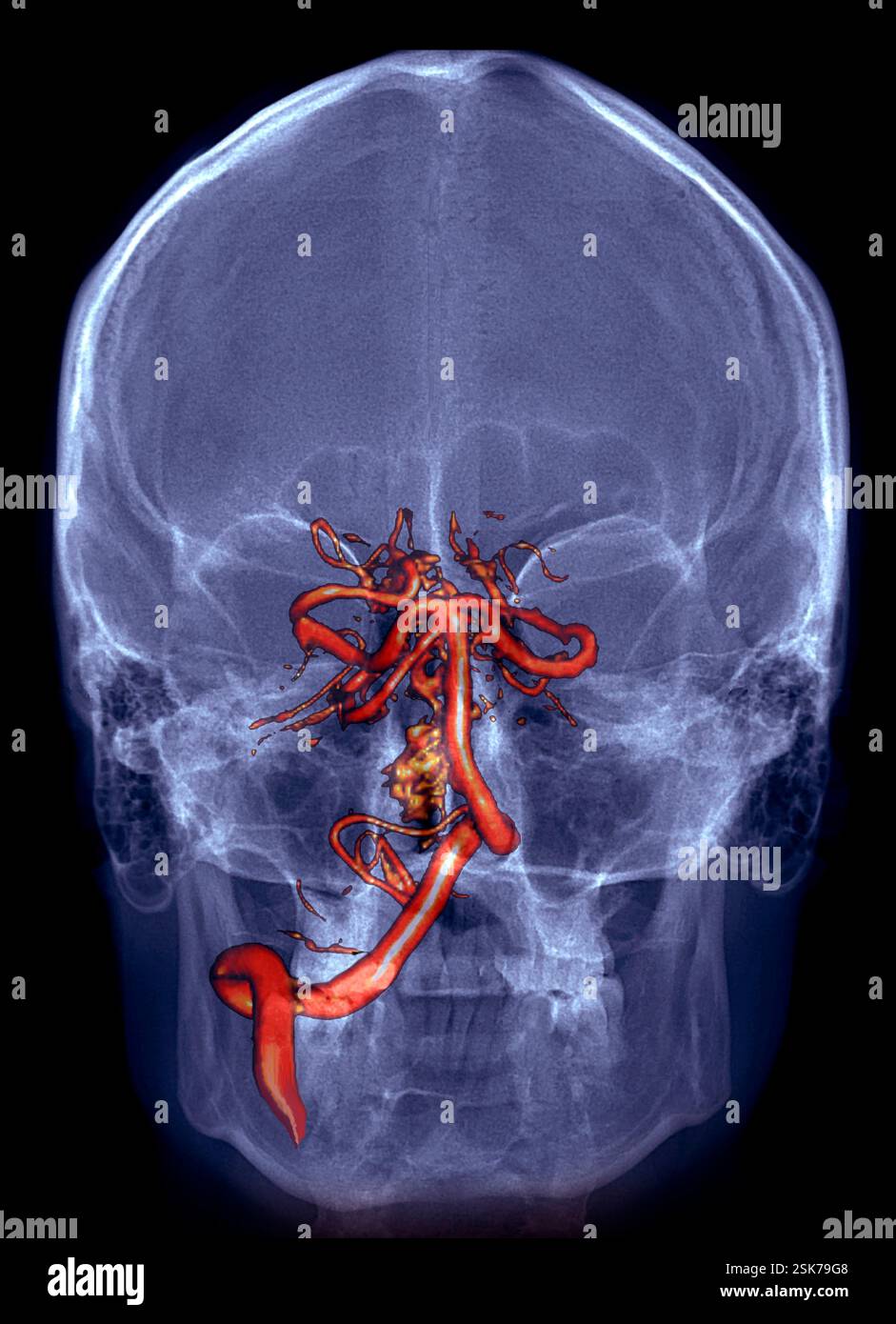 Coloured three-dimensional (3D) Angiography Computed Tomography (CT) scan in front view of a ...